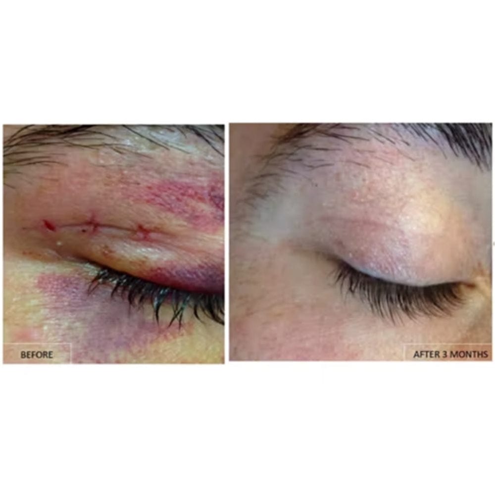 Kelo-Cote Scar Gel 15g | Meaghers.ie — Meaghers Pharmacy